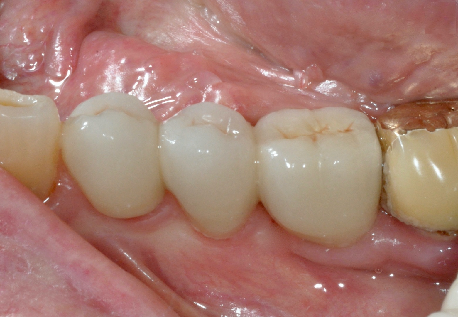 Prosthetic rehabilitation with short GTB implants: A case report with ...